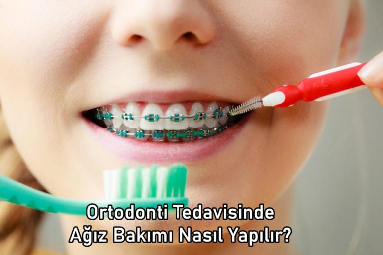 Ortodonti Tedavisinde Ağız Bakımı Nasıl Yapılır? | Dr. Dt. Bircan ...